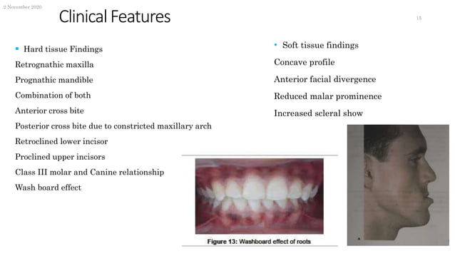 An overview of class III treatment in fixed Orthodontics by MBT system ...