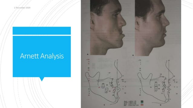 An overview of class III treatment in fixed Orthodontics by MBT system | PPTX
