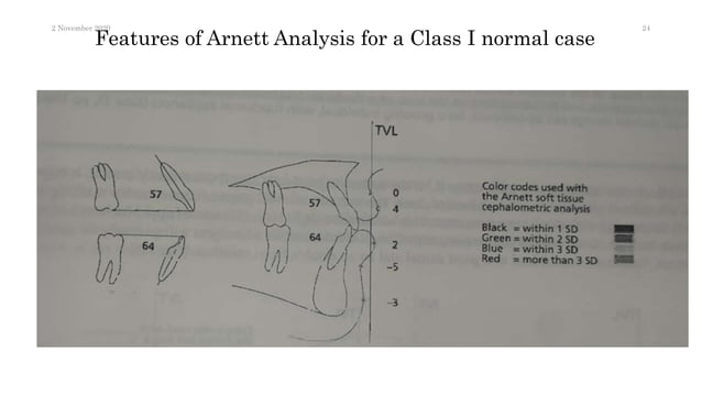 An overview of class III treatment in fixed Orthodontics by MBT system | PPTX