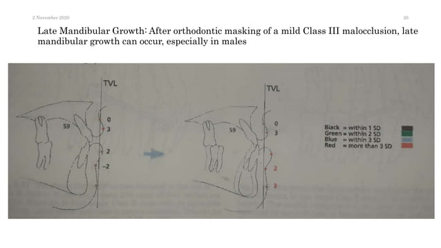 An overview of class III treatment in fixed Orthodontics by MBT system | PPTX