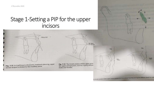 An overview of class III treatment in fixed Orthodontics by MBT system | PPTX