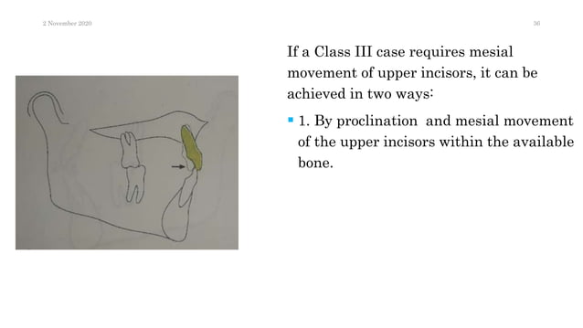 An overview of class III treatment in fixed Orthodontics by MBT system | PPTX