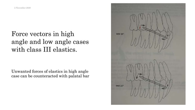 An overview of class III treatment in fixed Orthodontics by MBT system ...