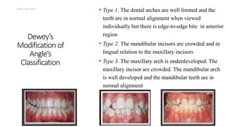 An overview of class III treatment in fixed Orthodontics by MBT system ...
