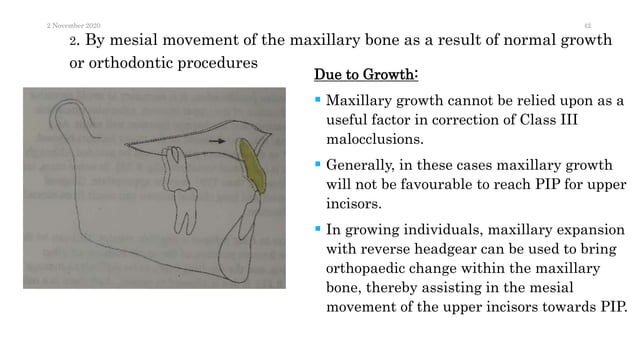 An overview of class III treatment in fixed Orthodontics by MBT system | PPTX