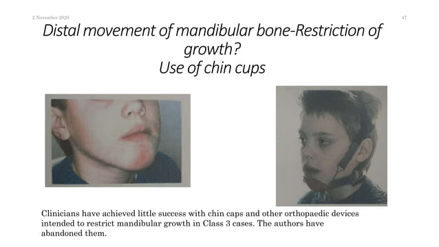 An overview of class III treatment in fixed Orthodontics by MBT system ...