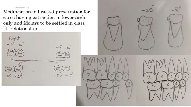 An overview of class III treatment in fixed Orthodontics by MBT system ...