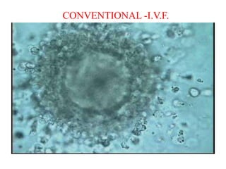 An overview of IVF/ICSI | PPTX