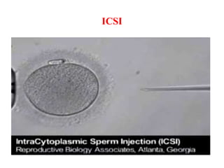 An overview of IVF/ICSI | PPTX