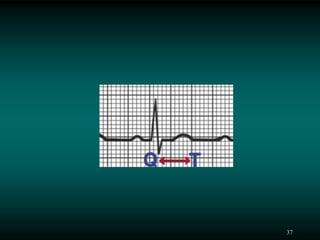 An overview of paediatric ECG | PDF