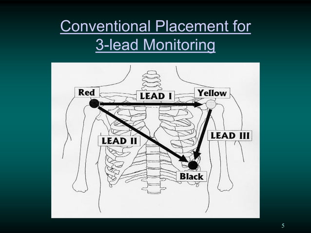 An overview of paediatric ECG | PDF