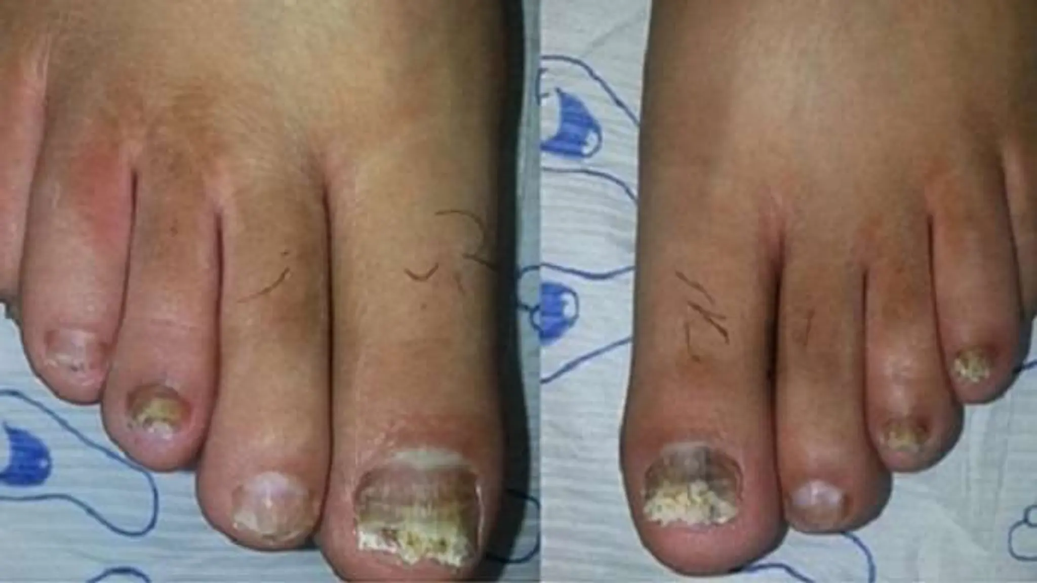 An Overview of the Signs and Prevention of Fungal Toenail | PPT