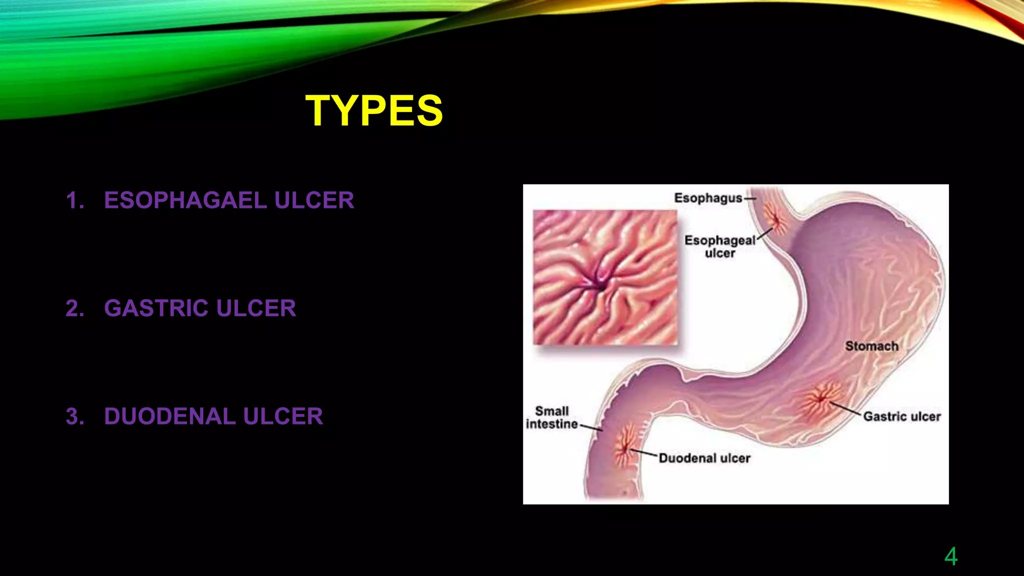 Treatments for PEPTIC ULCER | PPTX | Digestive Disorders | Diseases and ...