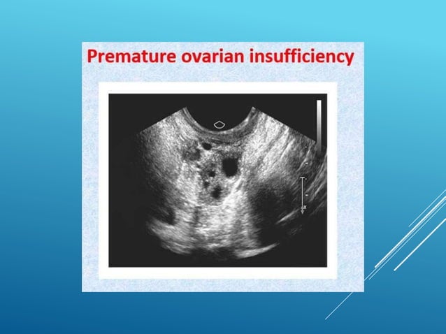 anovulation (2).pptx