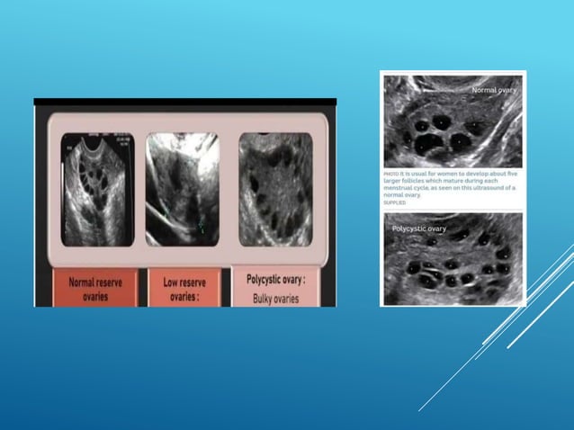 anovulation (2).pptx