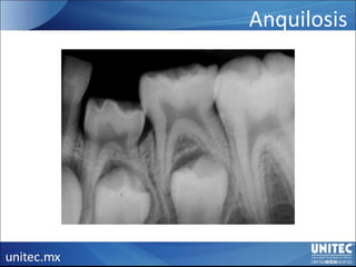 Anquilosis en dientes primarios | PPT