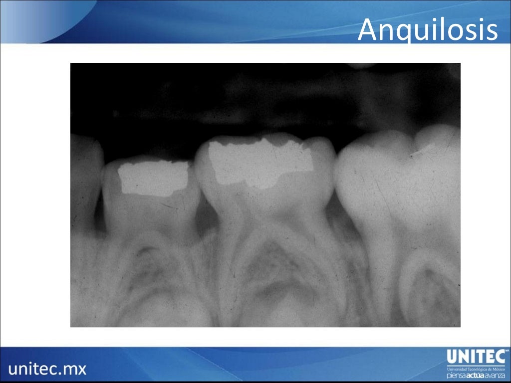 Anquilosis en dientes primarios