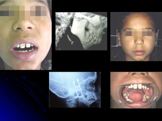 Anquilosis temporomandibular | PPT