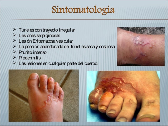 Anquilostomiasis y Larva Migrans Cutánea