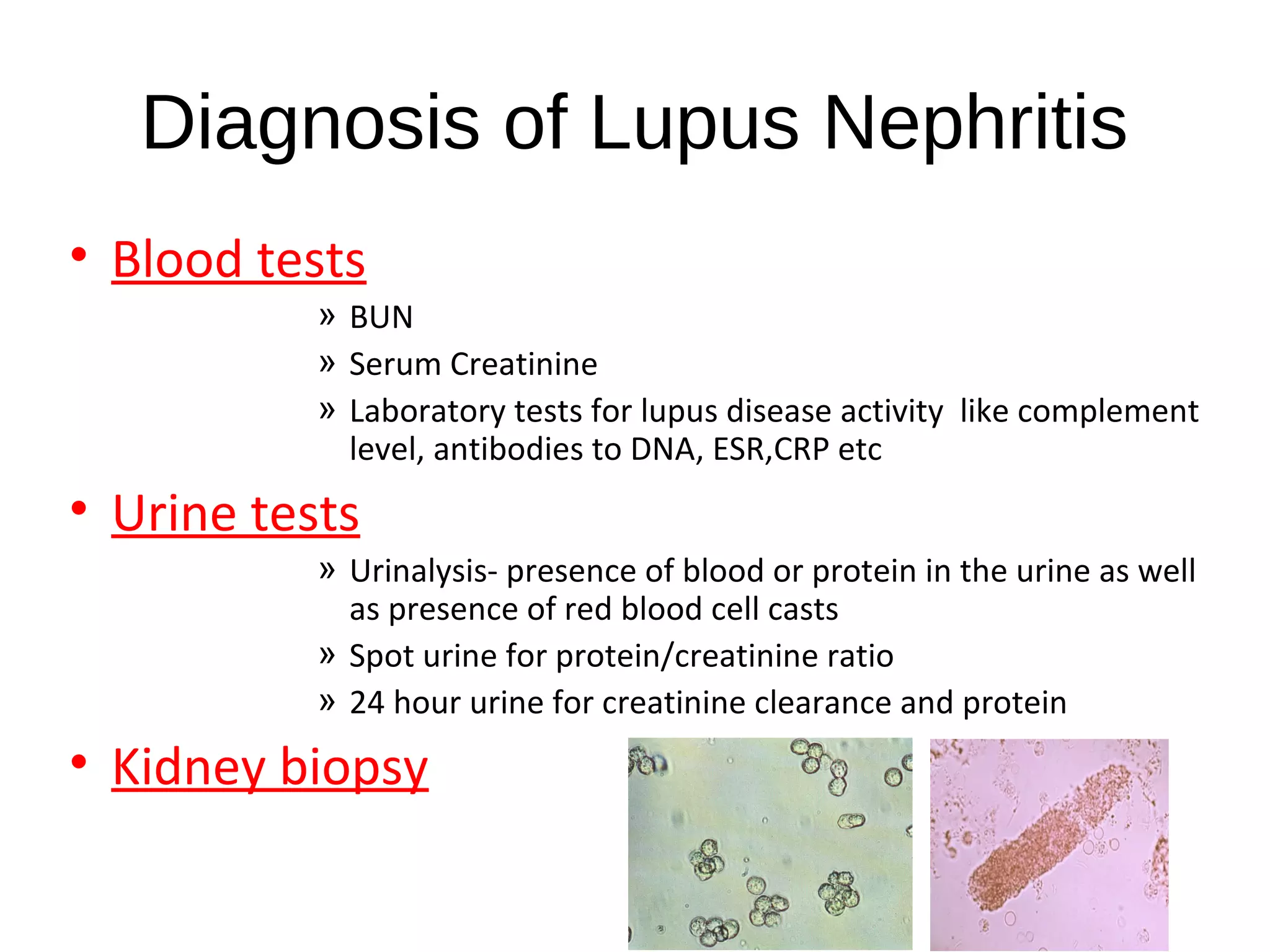 Dialysis and Transplant for Lupus Nephritis | PPT