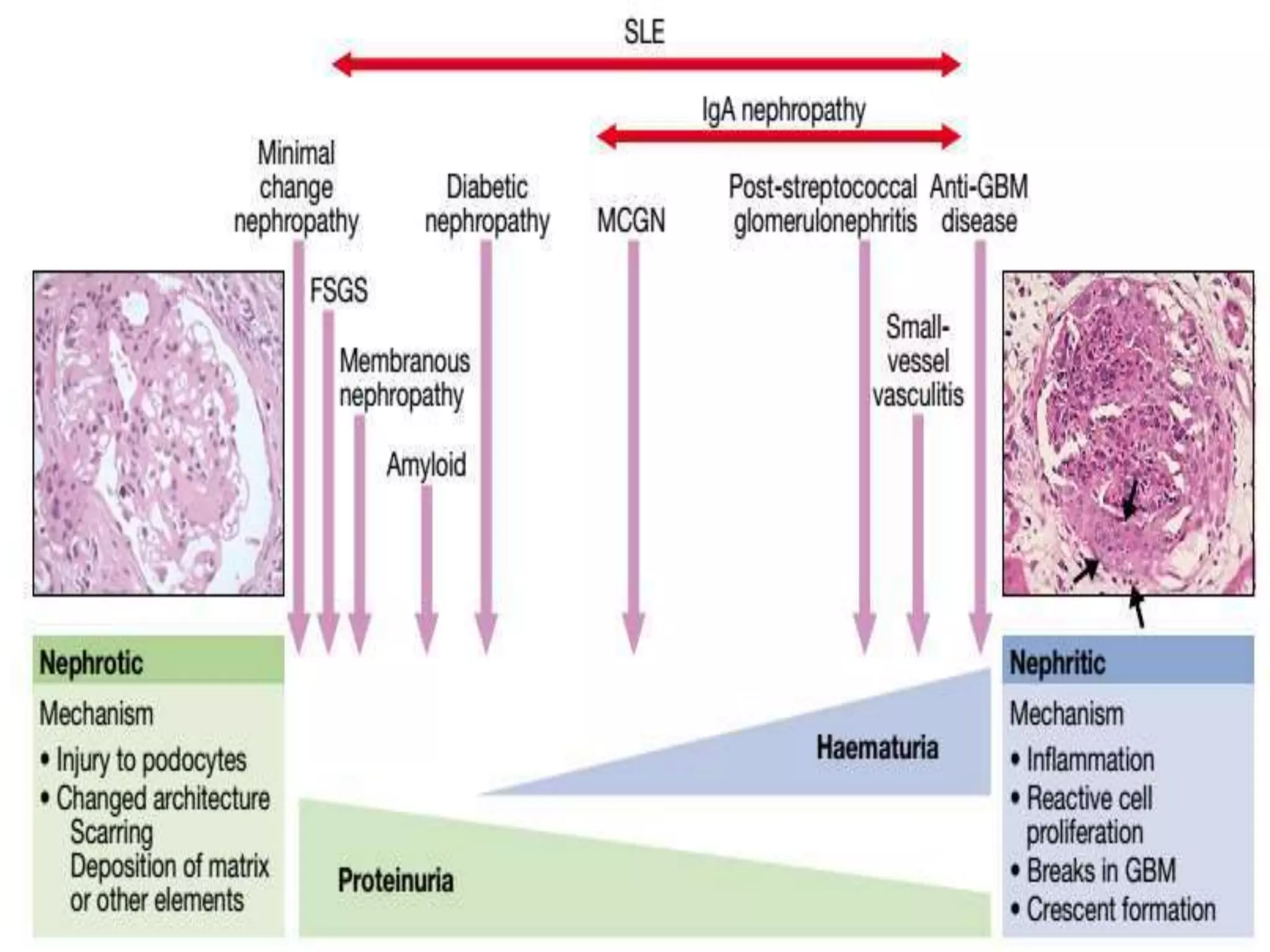 Acute Nephritic Syndromes | PPTX