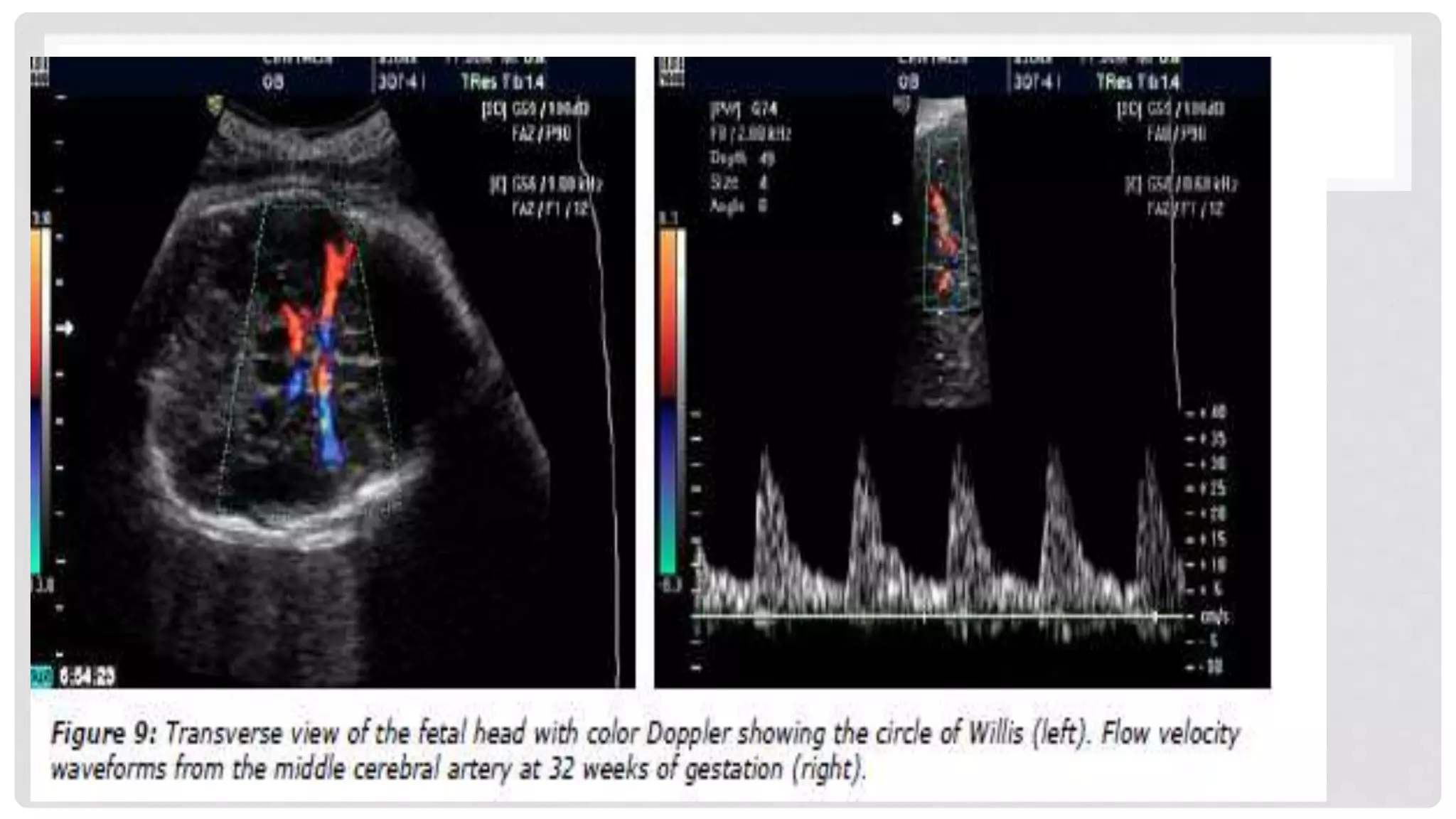 Obstetric Colour Doppler Study | PPTX
