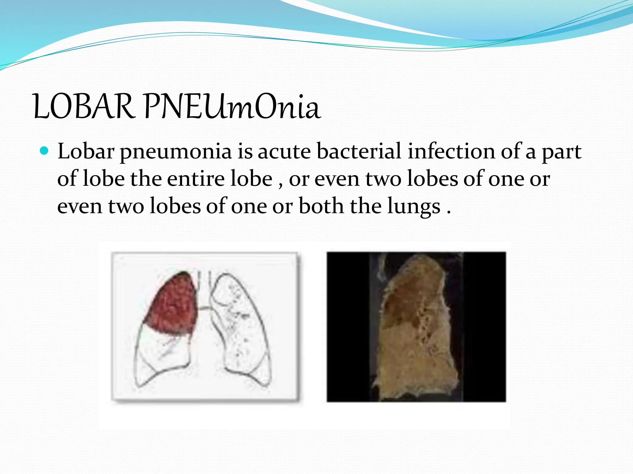 Pneumonia disease symptoms Care prevention and causes | PPTX
