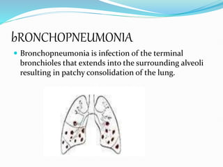 Pneumonia disease symptoms Care prevention and causes | PPTX