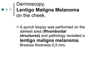 Dermoscopy. Lentigo maligna melanoma on the cheek. | PPT