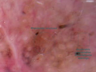 Dermoscopy. Lentigo maligna melanoma on the cheek. | PPT | Skin and ...