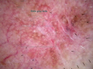 Dermoscopy. Lentigo Maligna Melanoma. | PPT