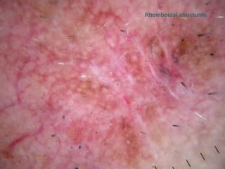 Dermoscopy. Lentigo Maligna Melanoma. | PPT