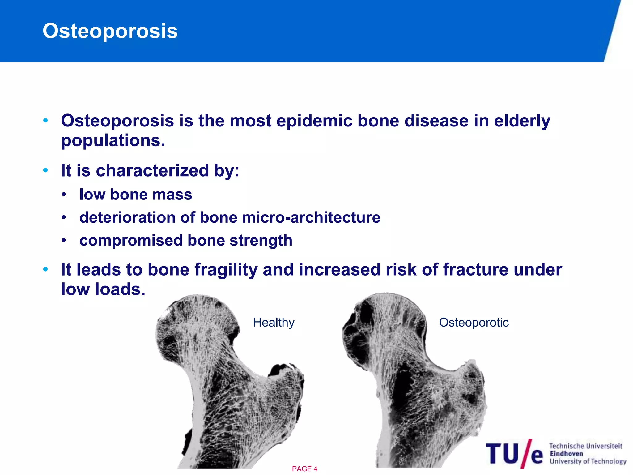 ANSYS USERMAT for Prediction of Bone Failure | PPTX