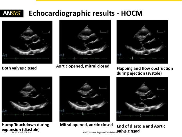 Simulations of Hypertrophic Obstructive Cardiomyopathy (HOCM) in a Hu…