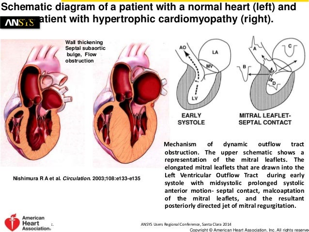 Simulations of Hypertrophic Obstructive Cardiomyopathy (HOCM) in a Hu…