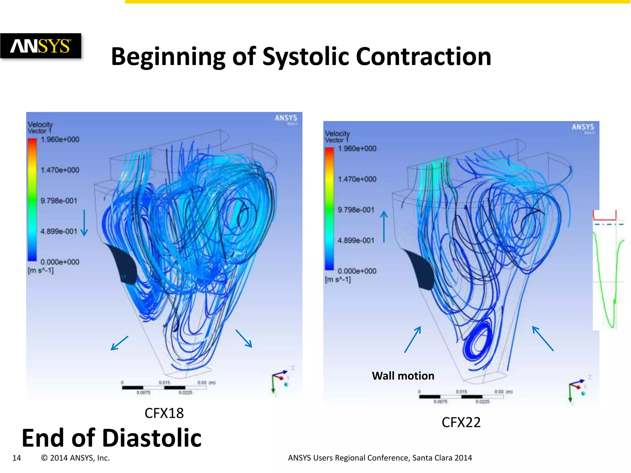 Simulations of Hypertrophic Obstructive Cardiomyopathy (HOCM) in a ...