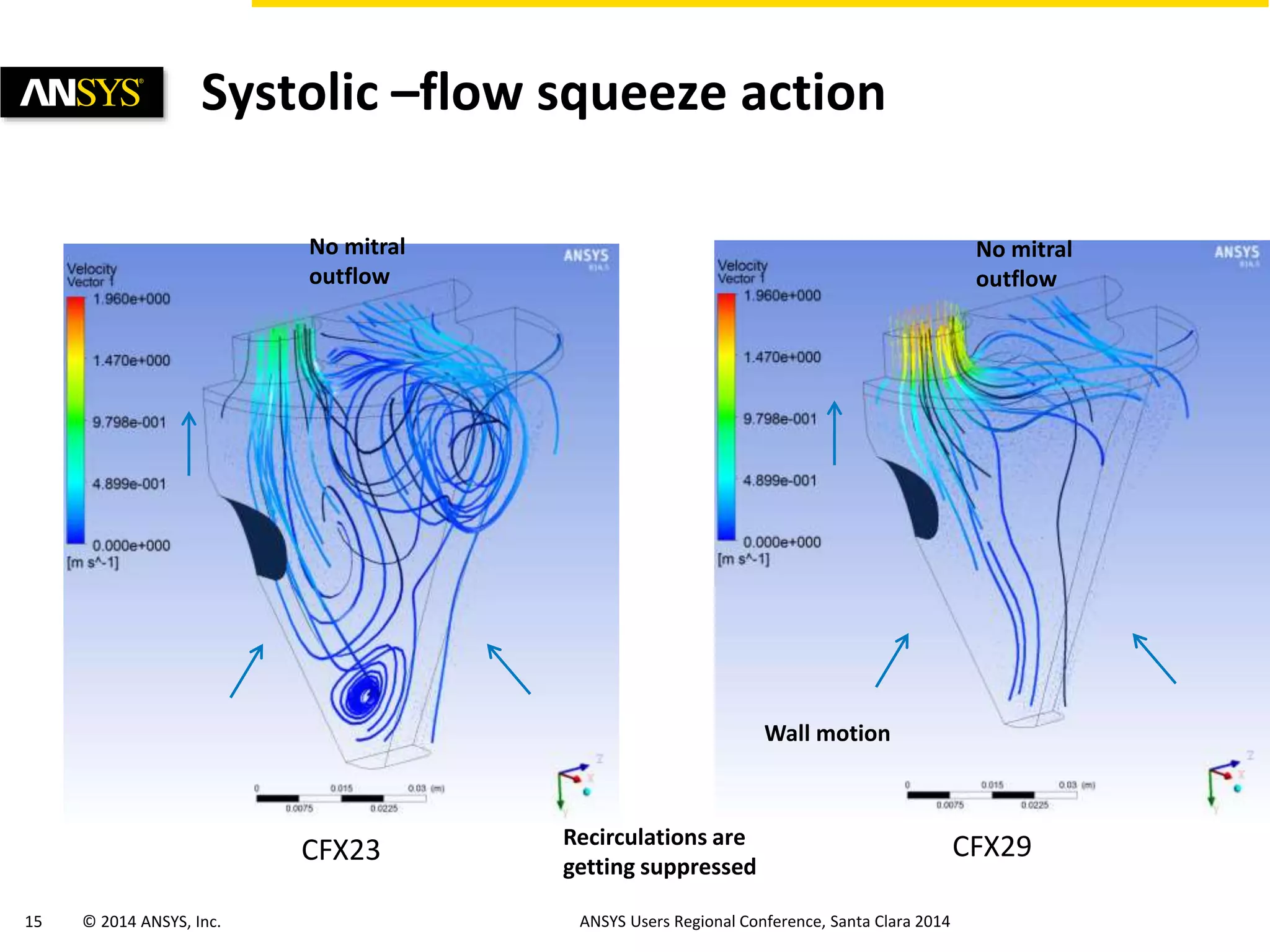 Simulations of Hypertrophic Obstructive Cardiomyopathy (HOCM) in a ...