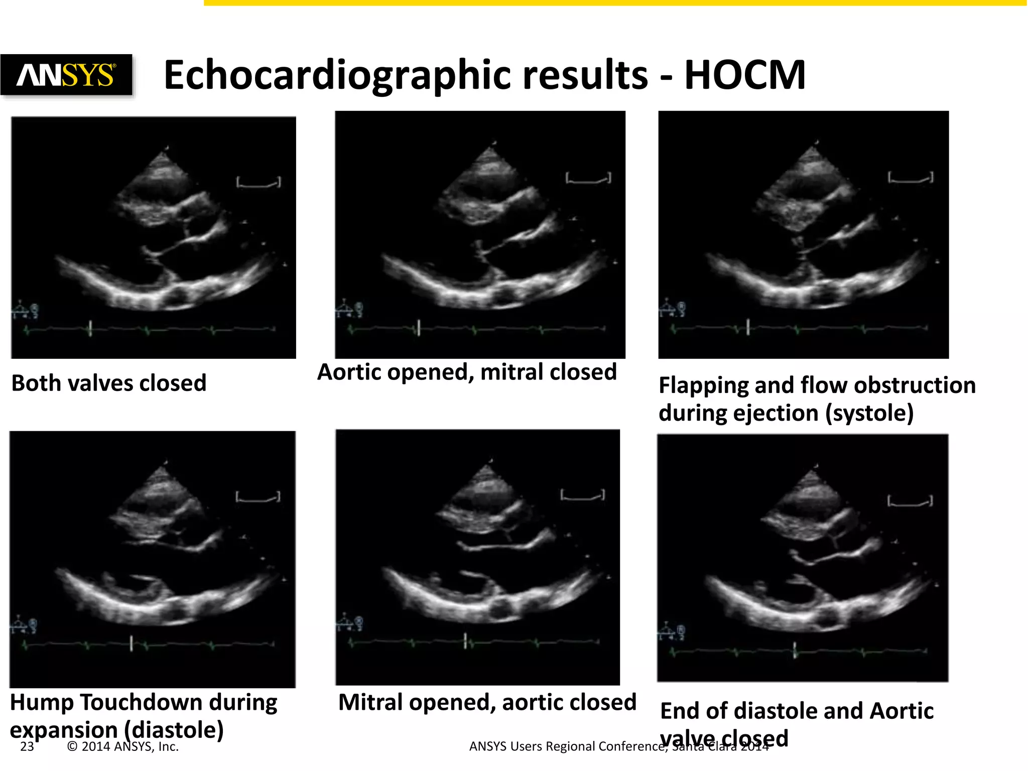 Simulations of Hypertrophic Obstructive Cardiomyopathy (HOCM) in a ...