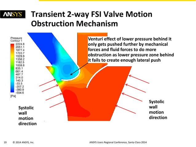 Simulations of Hypertrophic Obstructive Cardiomyopathy (HOCM) in a Human Heart Left Ventricle ...