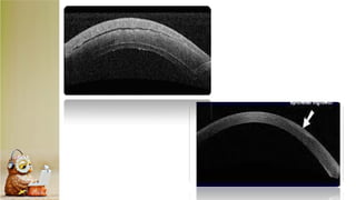 Anterior Segment OCT in Ophthalmology | PDF