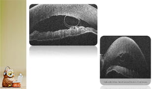 Anterior Segment OCT in Ophthalmology | PDF