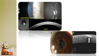 Anterior Segment OCT in Ophthalmology | PDF