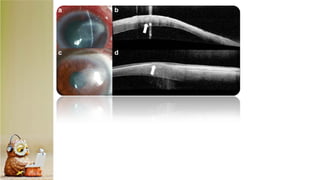Anterior Segment OCT in Ophthalmology | PDF