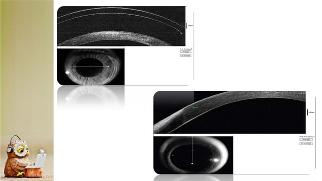 Anterior Segment OCT in Ophthalmology | PDF | Science