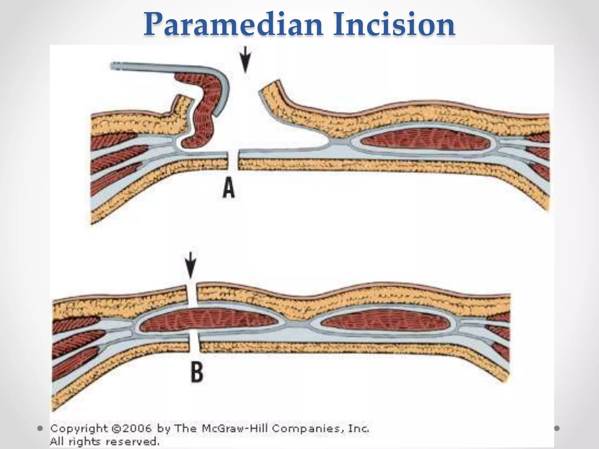 Surgical Anatomy of anterior abdominal wall | PPTX
