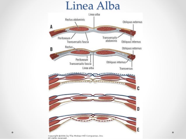 Linea Alba Hernia