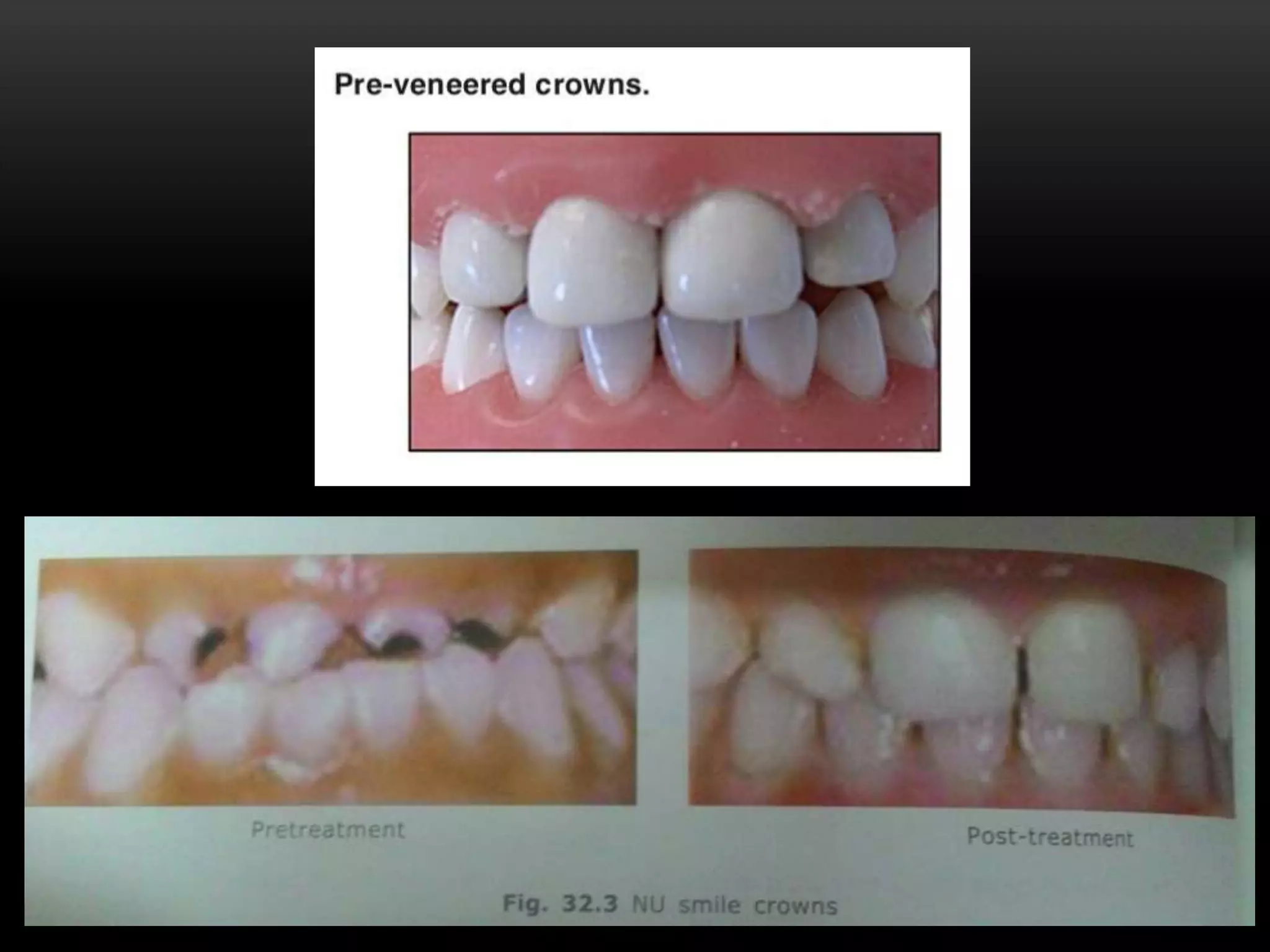 Anterior crowns in pediatric dentistry | PPTX