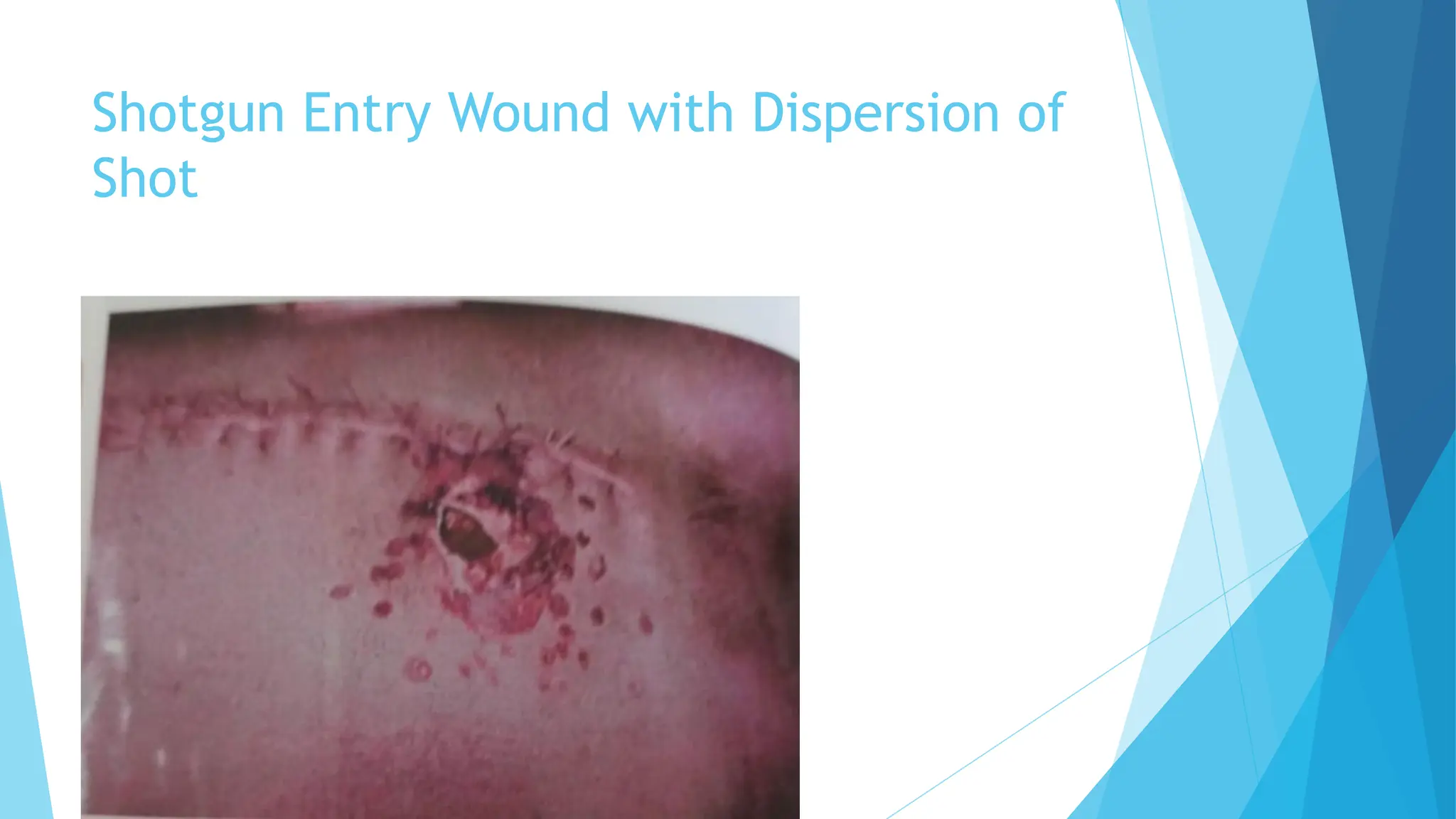 Ante-mortem and Post-mortem injuries - Copy.pdf