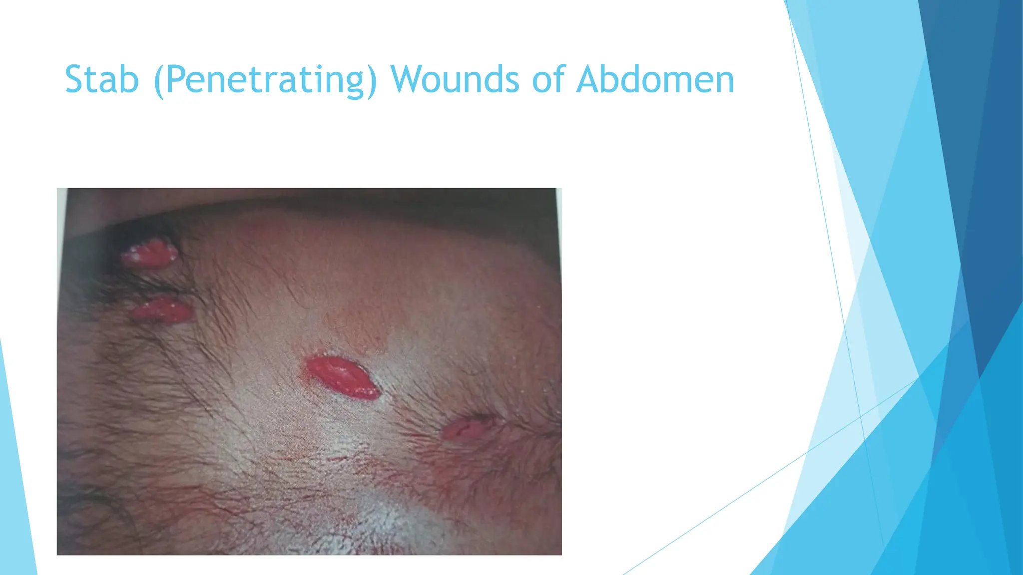 Ante-mortem and Post-mortem injuries - Copy.pdf