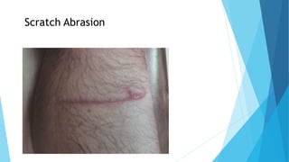 Ante-mortem and Post-mortem injuries - Copy.pdf